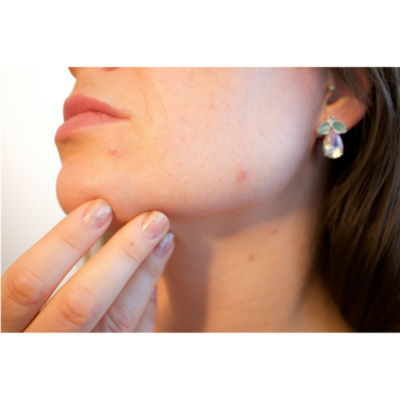 Acne and Hypothyroidism - Dr. Lori Kalie
